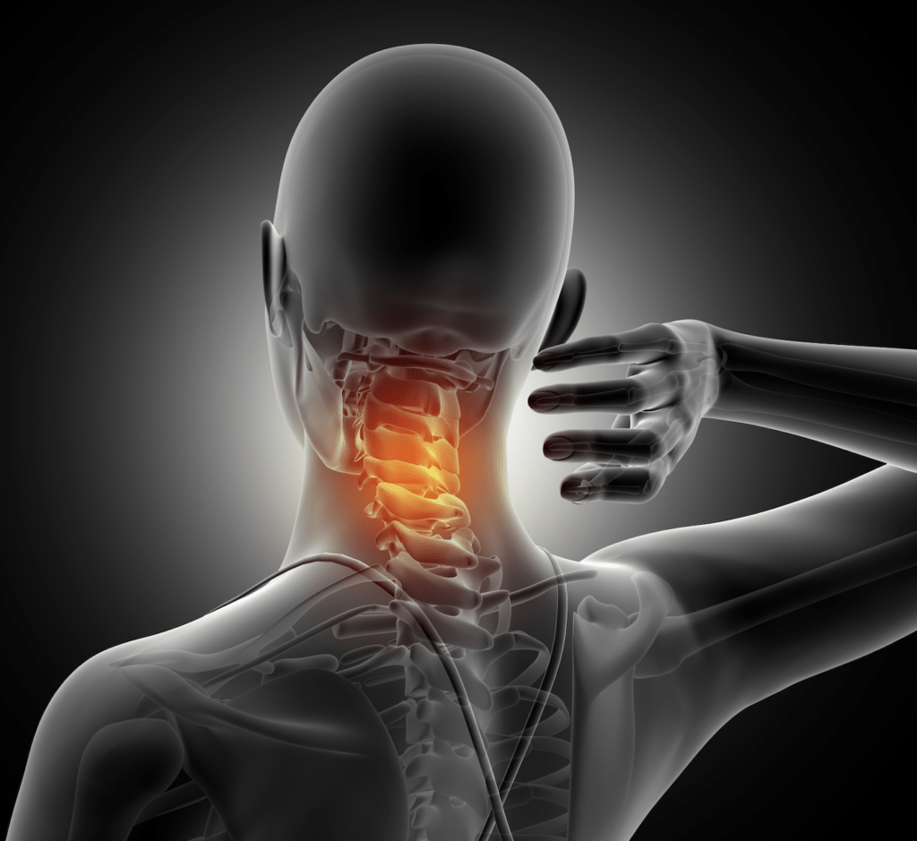 Whiplash o Latigazo Cervical: causas, síntomas y tratamiento – Sportsalud